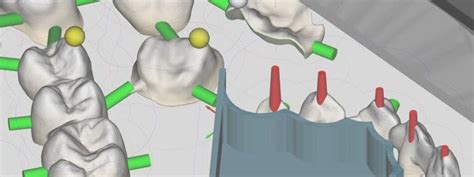 Hyperdent® Dental Cam Software 3d Prime Technologies