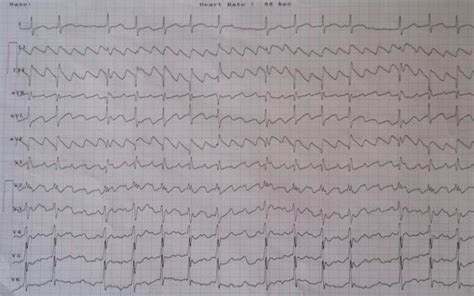 An Electrocardiogram After Cardiac Surgery Demonstrate Atrial Flutter Download Scientific