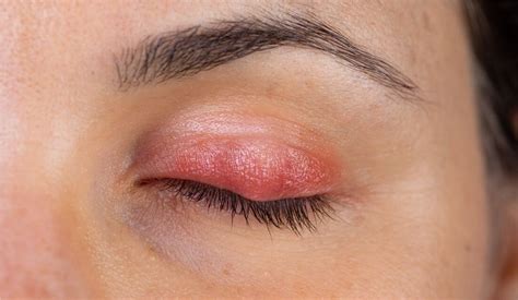 Before And After Blephex