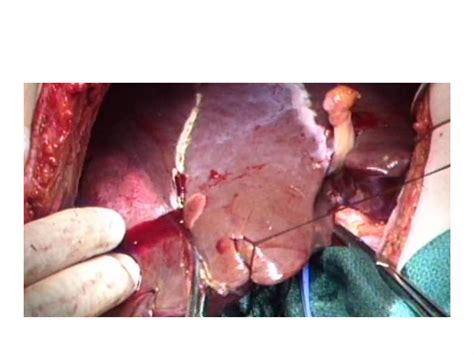 Right Hepatectomy Step By Step Description For Surgeon Pptx