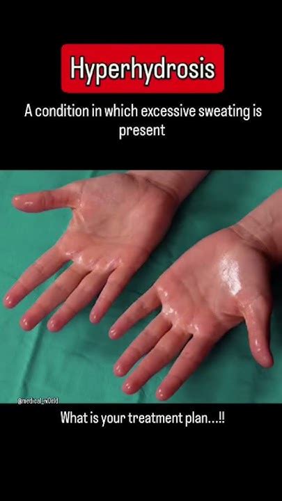 Hyperhydrosis Excessive Sweating Drbeast Hyperhydrosis Youtube