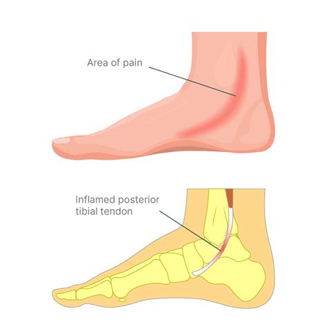 Tibialis Posterior Tendinopathy Diagnosis Causes And Treatments