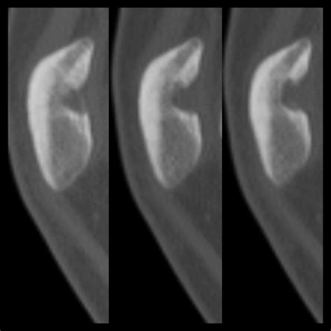 Tomás Pascual On Linkedin 📚dorsal Defects Of The Patella Are Benign Subchondral Lesions Of Unknown…