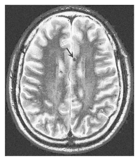 Filtering Processing A Image With Noise B Image After Filtering