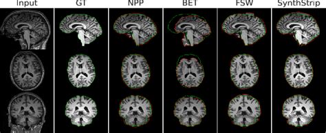 Neural Pre Processing A Learning Framework For End To End Brain Mri Pre Processing Paper And Code