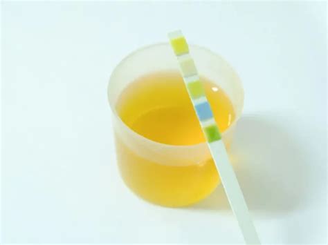 Calcium Creatinine Ratio 24 Hrs Urine Test Best Pathology Lab And