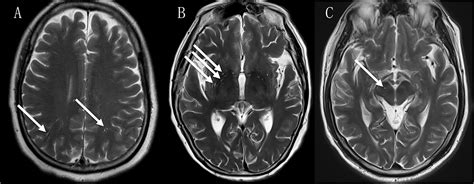 Frontiers Enlarged Perivascular Spaces Neuroinflammation And