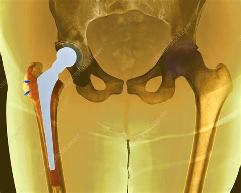 Total Hip Replacement X Ray Images At Greg Booth Blog