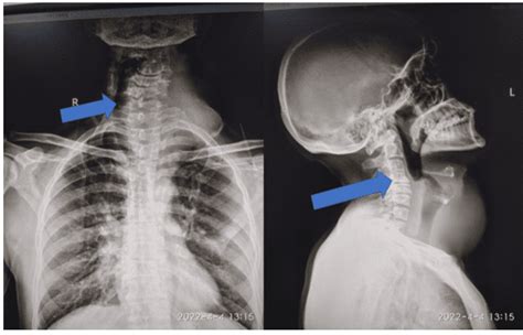 Tracheal Deviation X Ray