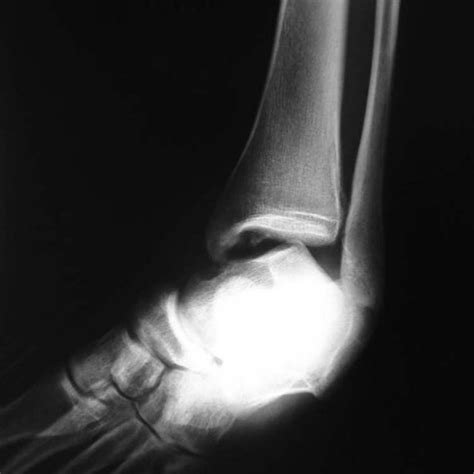 The Anteroposterior View Demonstrates Tibiotalar Joint Dislocation Download Scientific Diagram
