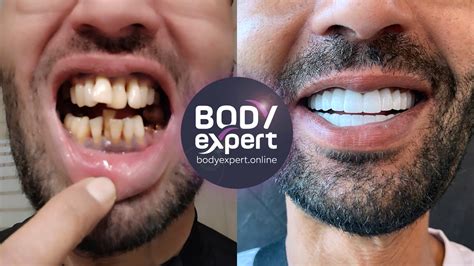 Implants dentaires Avant Après résultats après la pose Body Expert
