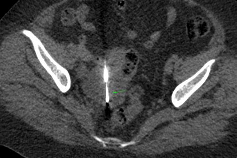 Case 48 Ovarian Mass Biopsy Approach Anterior Or Posterior