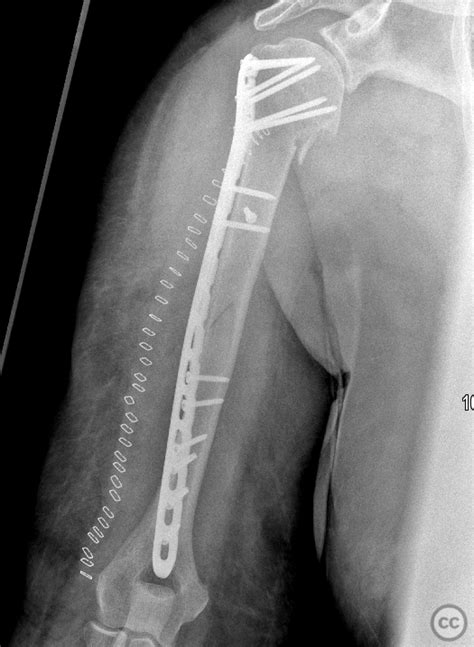 Segmental Humerus Fracture Helix Philos Plate Technique