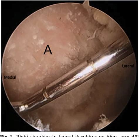 Figure 1 From Superior Capsular Reconstruction With The Addition Of An