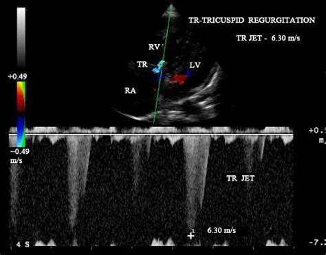 Apical 4 Chamber View Cw Doppler Showing High Velocity Tr Tricuspid