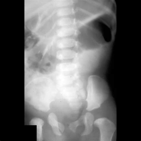 Congenital Hypothyroidism Pediatric Radiology Reference Article