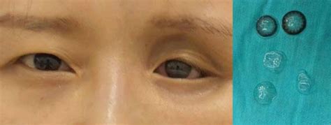 눈 안에서 없어진 렌즈 5개 나왔다 中 30대 여성 어떻게 이런 일이 당신의 건강가이드 헬스조선