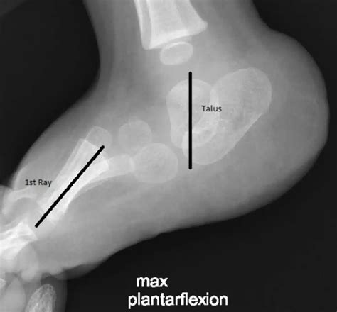 Talo Verticale Congenito Nel Neonato Sintomi Cura Con Metodo Ponseti