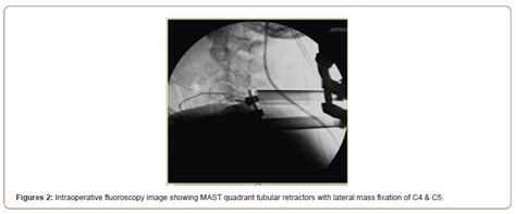 Surgical Management Of A Cervical Synovial Cyst By Minimally Invasive