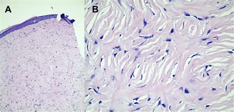 Fibroepithelial Polyp Histology