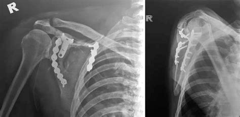 Postoperative Right Shoulder Anteroposterior And Y Scapular View