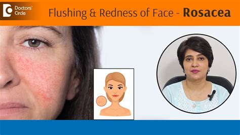 When To Be Worried About Skin Flushing Blushing Flushed Face Rosacea