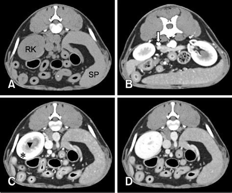Transverse Computed Tomography Images With No Enhancement A 5 Sec