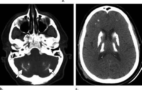 Hyperparathyroidisn In Two Patients A Axial Unenhanced Ct Image