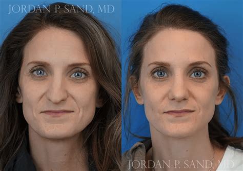 Rhinoplasty 10 Sand Plastic Surgery Of Spokane