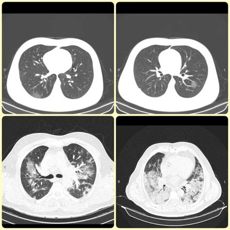 Chest Computed Tomography Ct Scans Of Different Patterns Of Covid 19