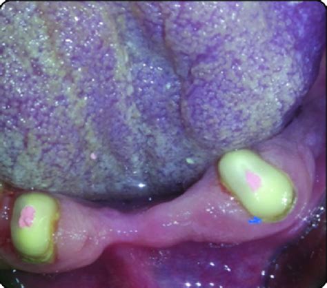Dome Shape Abutment Preparation Tooth Supported Overdenture Retained By Download Scientific