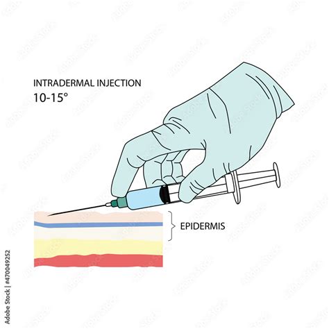Intradermal Injection Effective Methods Of Administration Of Drugs And