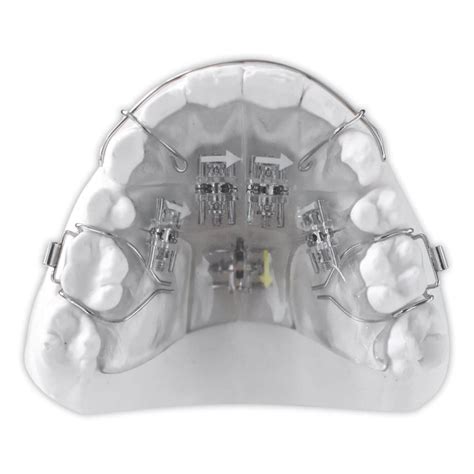 Buy Palate Expander Online Expanders