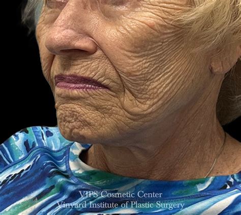 Laser Skin Resurfacing Before And After Photos Vinyard Institute Of