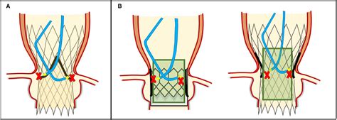 Sex‐specific Considerations In Degenerative Aortic Stenosis For Female