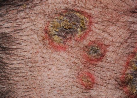 Derm 4 5 Pyoderma Flashcards Quizlet