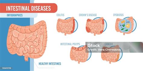 Flat Cartoon Infographic Intestines Diseases Vector Illustration