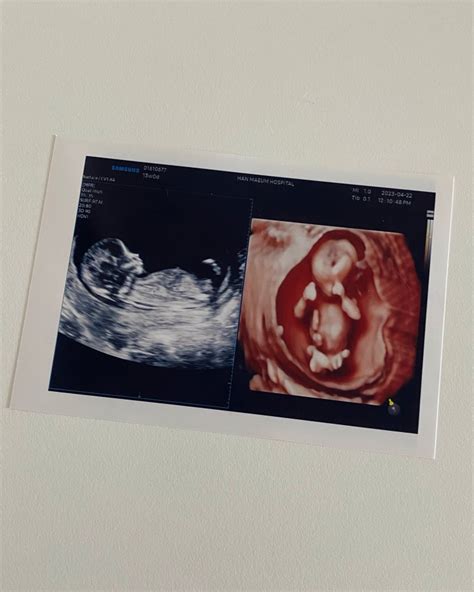 임신 13주1일 1차 기형아검사 성별힌트 창원한마음병원 산부인과 네이버 블로그