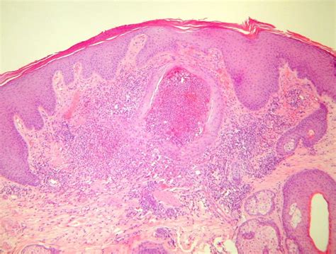 Folliculitis Differential Diagnoses Yeqz