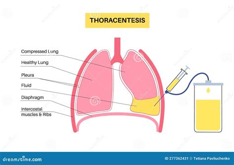 Thoracentesis Medical Procedure Stock Vector Illustration Of Empyema