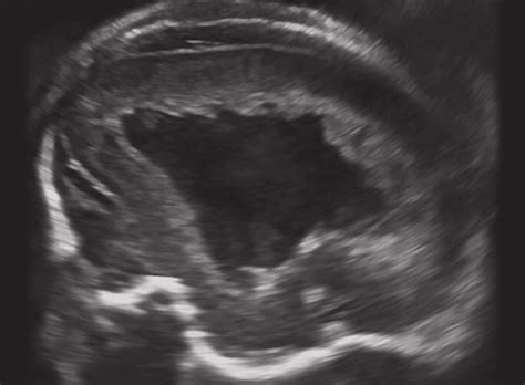 Periventricular Nodular Heterotopia Irregular Surface Of The Enlarged Download Scientific