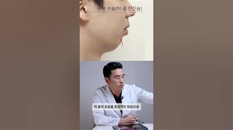 노트성형외과 남자의 무턱수술 Youtube