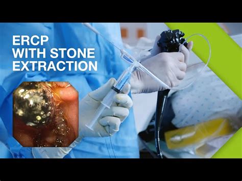 Ercp Stone Extraction Cracking Difficult Biliary Stones