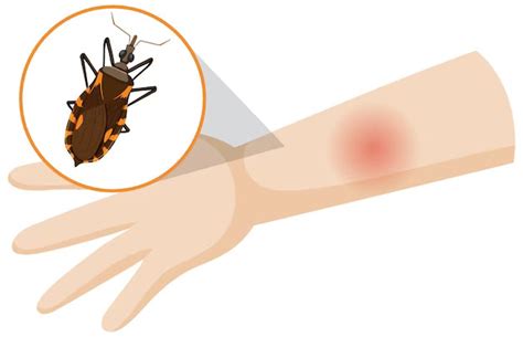 Chagas Disease Symptoms Causes Treatment Prevention And Genetic Testing