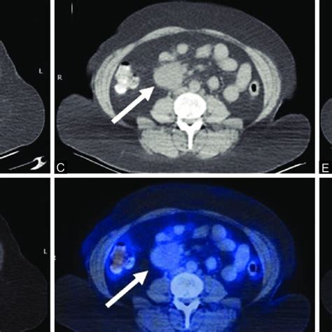 A F A Case Of Mesenteric Lymphoma Top Panel Ct Images Bottom