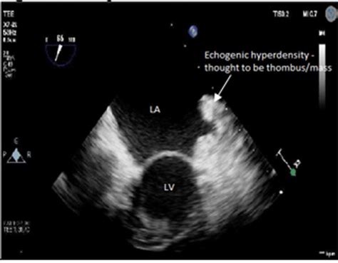 Intra Operative Tee Showing Echogenic Hyper Density In The Left Atrial Download Scientific