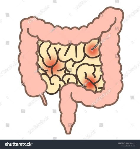 Illustration Crohns Disease Explaining Stock Illustration 2202804131
