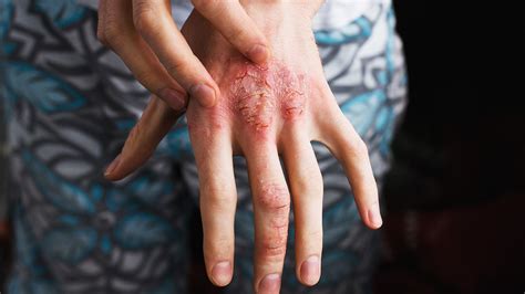 Diy Treatments For Scalp Psoriasis Irritation Everyday Health