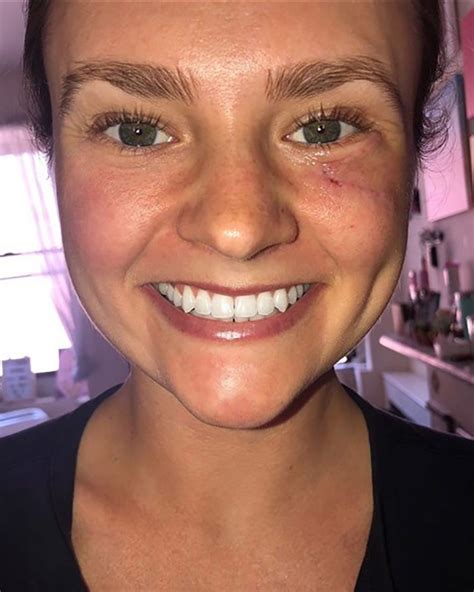 The “pimple” Under This Womans Eye Turned Out To Be Skin Cancer