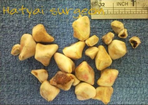 นิ่วในถุงน้ำดี อาการเป็นอย่างไร ปวดท้อง คลื่นไส้ ใช่อาการนิ่วไหม